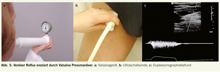 Aktuelle Diagnostik und Behandlung von Varizen – Aerzteverlag medinfo AG