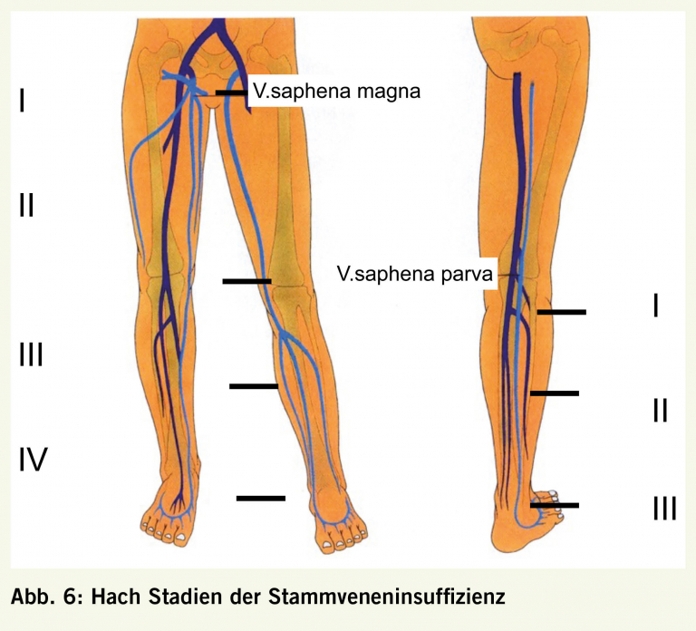 Aktuelle Diagnostik und Behandlung von Varizen – Aerzteverlag medinfo AG