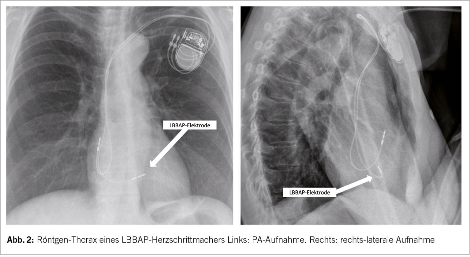 Left Bundle Branch Area Pacing – die Zukunft der Herzschrittmacher ...