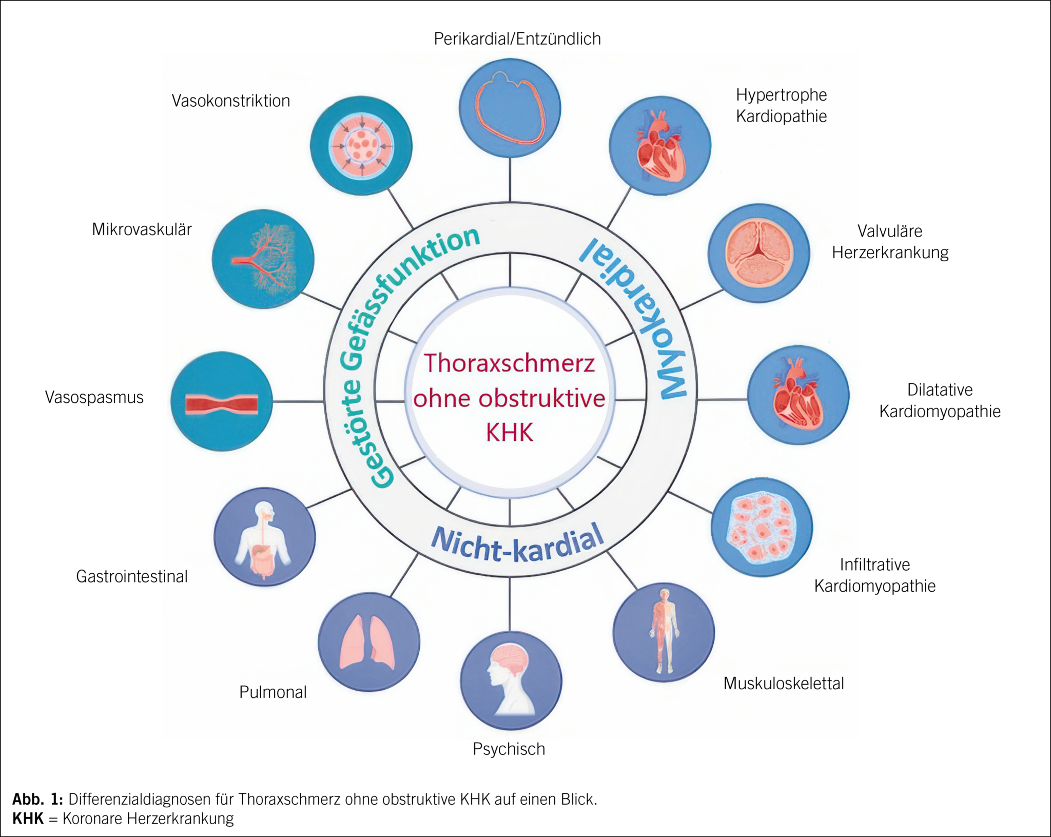Nicht obstruktive Koronarerkrankungen im Fokus: ­Definition, Diagnostik ...