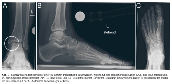 Osteochondrale Läsionen am Talus – Aerzteverlag medinfo AG