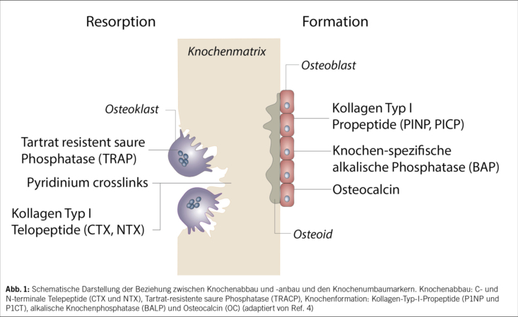 Stellenwert der Knochenumbau-parameter im Management der Osteoporose ...