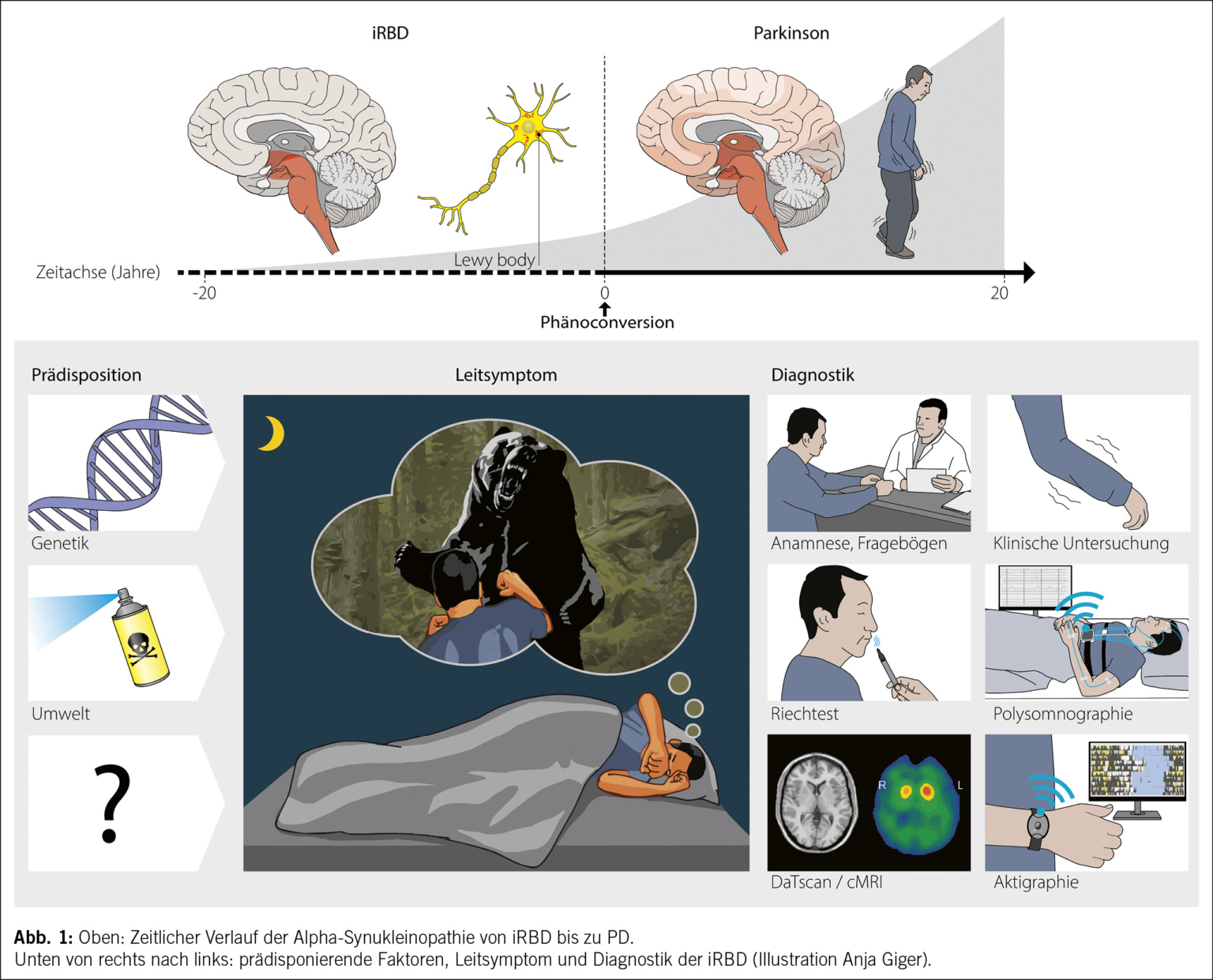REM-Schlaf-Verhaltensstörung – mehr als eine einfache Parasomnie ...